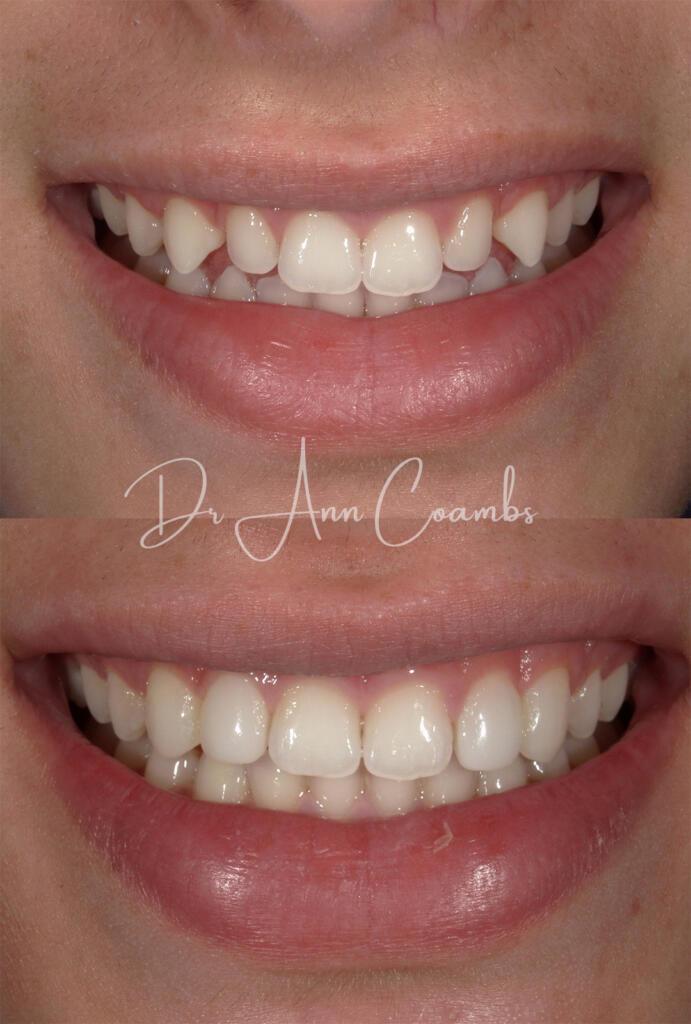 Reasons Patients Choose Bioclear for Cosmetic Dental Improvements ...